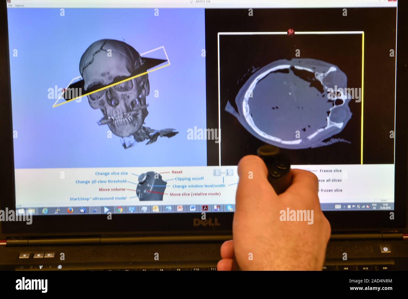 Forensics 3D virtual autopsy. 3D surface scan imagery being combined ...