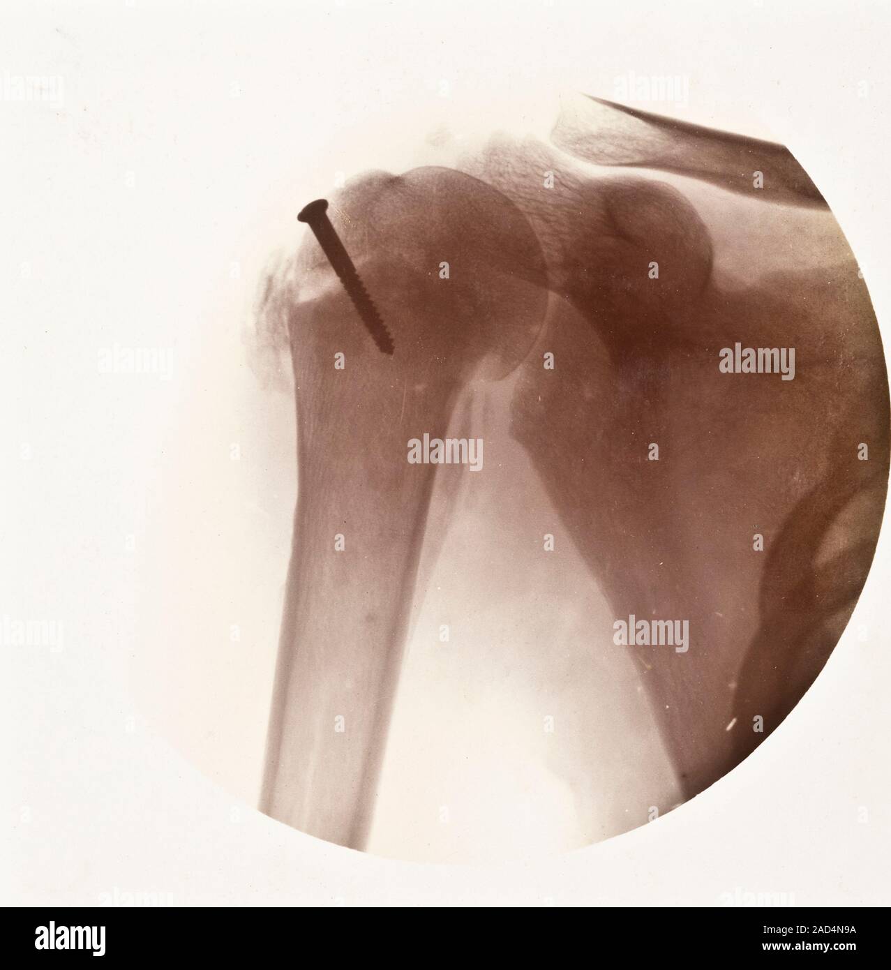 Shoulder screw X-ray, showing a fixation screw in the head of the ...