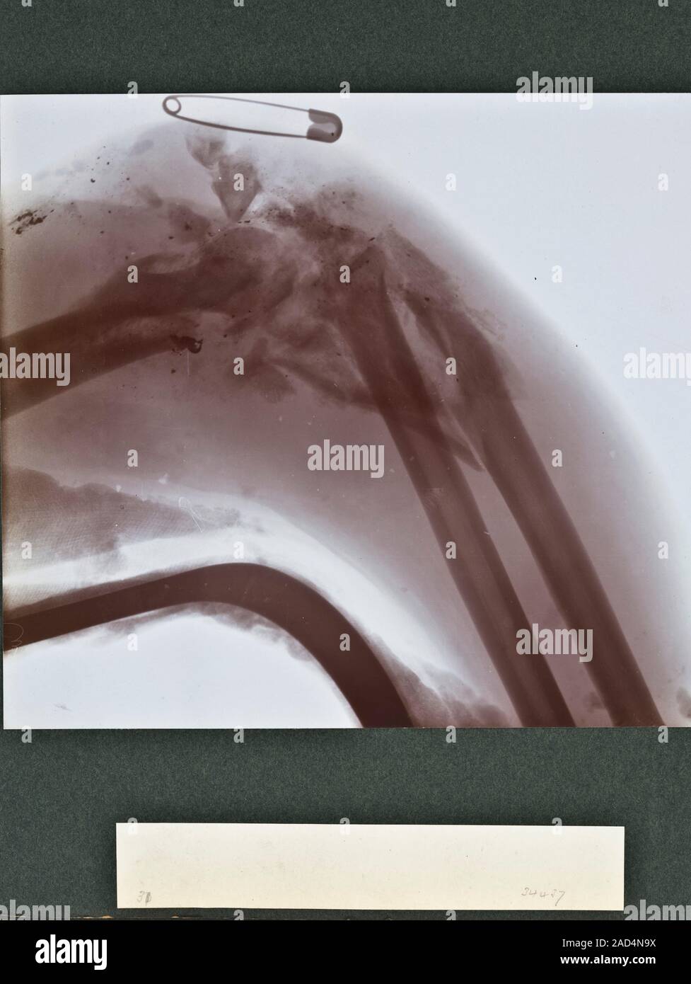 Shattered knee X-ray. This X-ray is from a collection dating from the ...