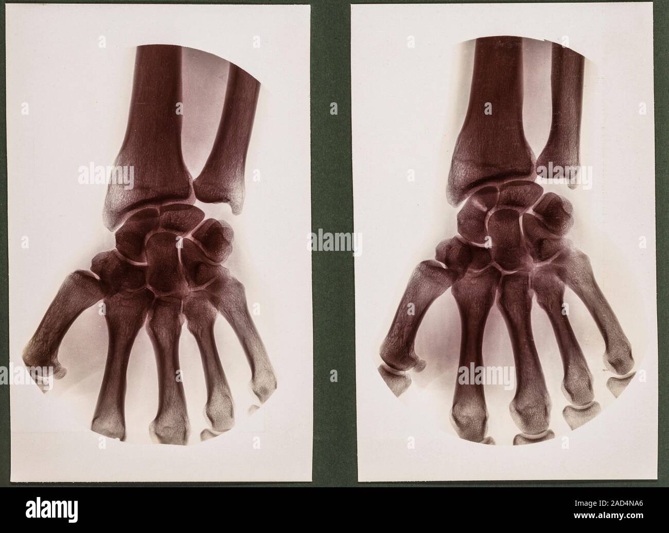 Wrist X-rays. These X-rays are from a collection dating from the period ...