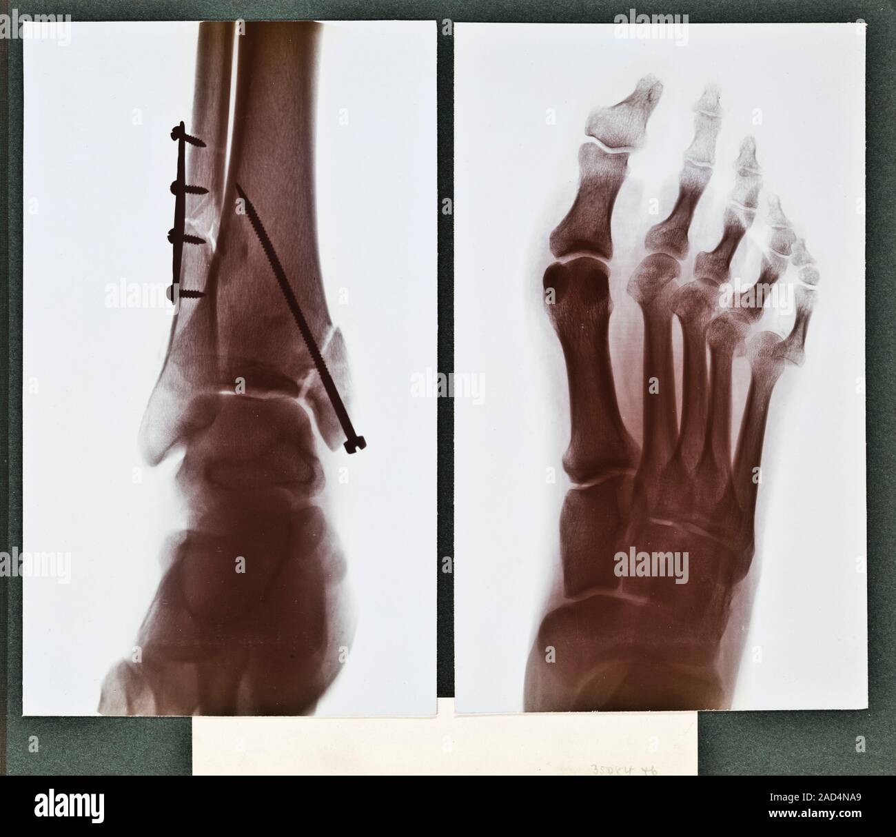 Ankle fixation X-ray, with screws and a plate (left) used to fix ...
