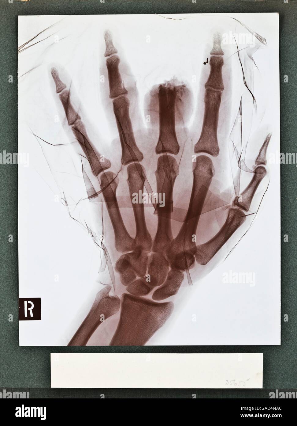 Finger injury X-ray, showing loss of the first two phalanges of the ...