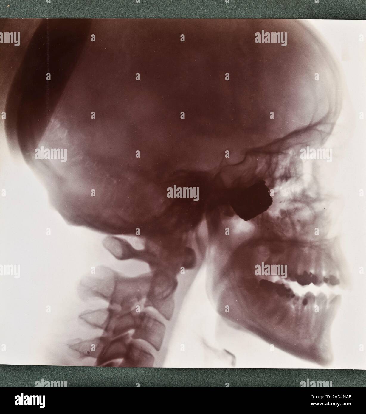 Shrapnel X-ray, showing a metallic foreign body lodged in the head near ...