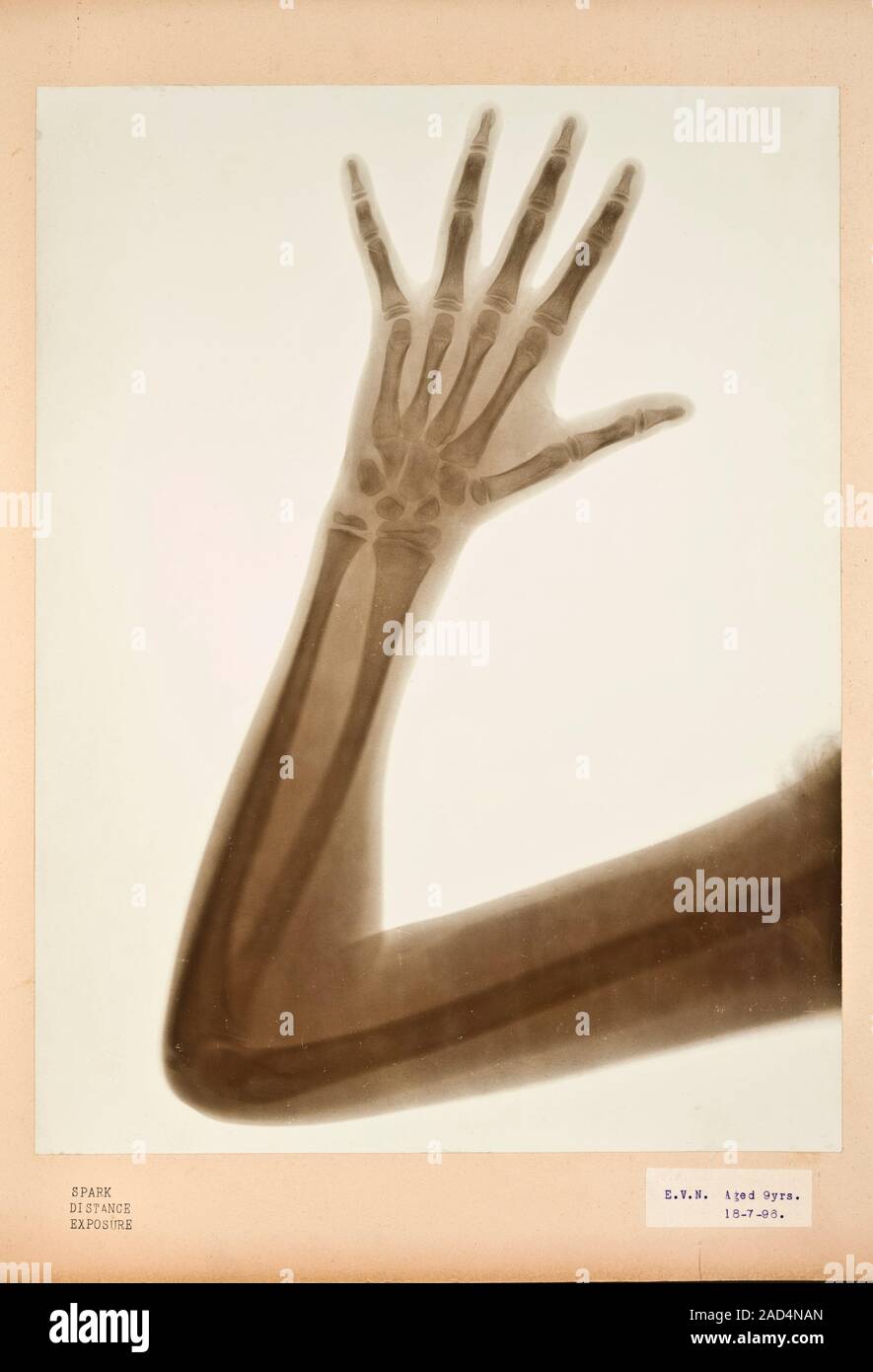 Child's arm X-ray. This X-ray is from a collection mostly dating from ...