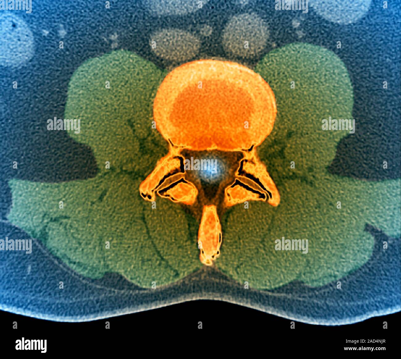 Normal lumbar vertebra. Coloured computed tomography (CT) scan of an ...