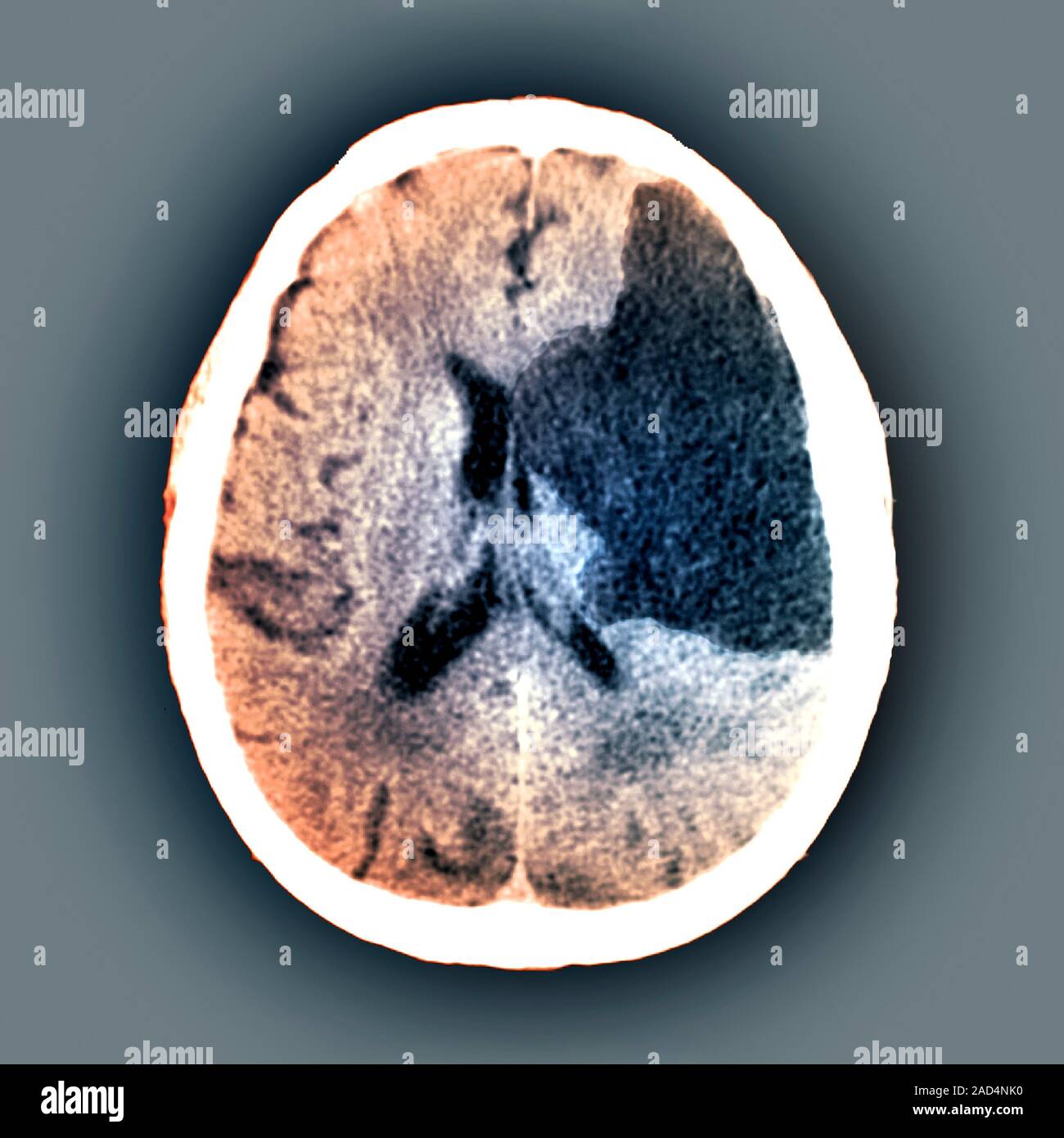 Brain In Stroke Ct Scan Coloured Computed Tomography Ct Scan Of An Axial Section Through The