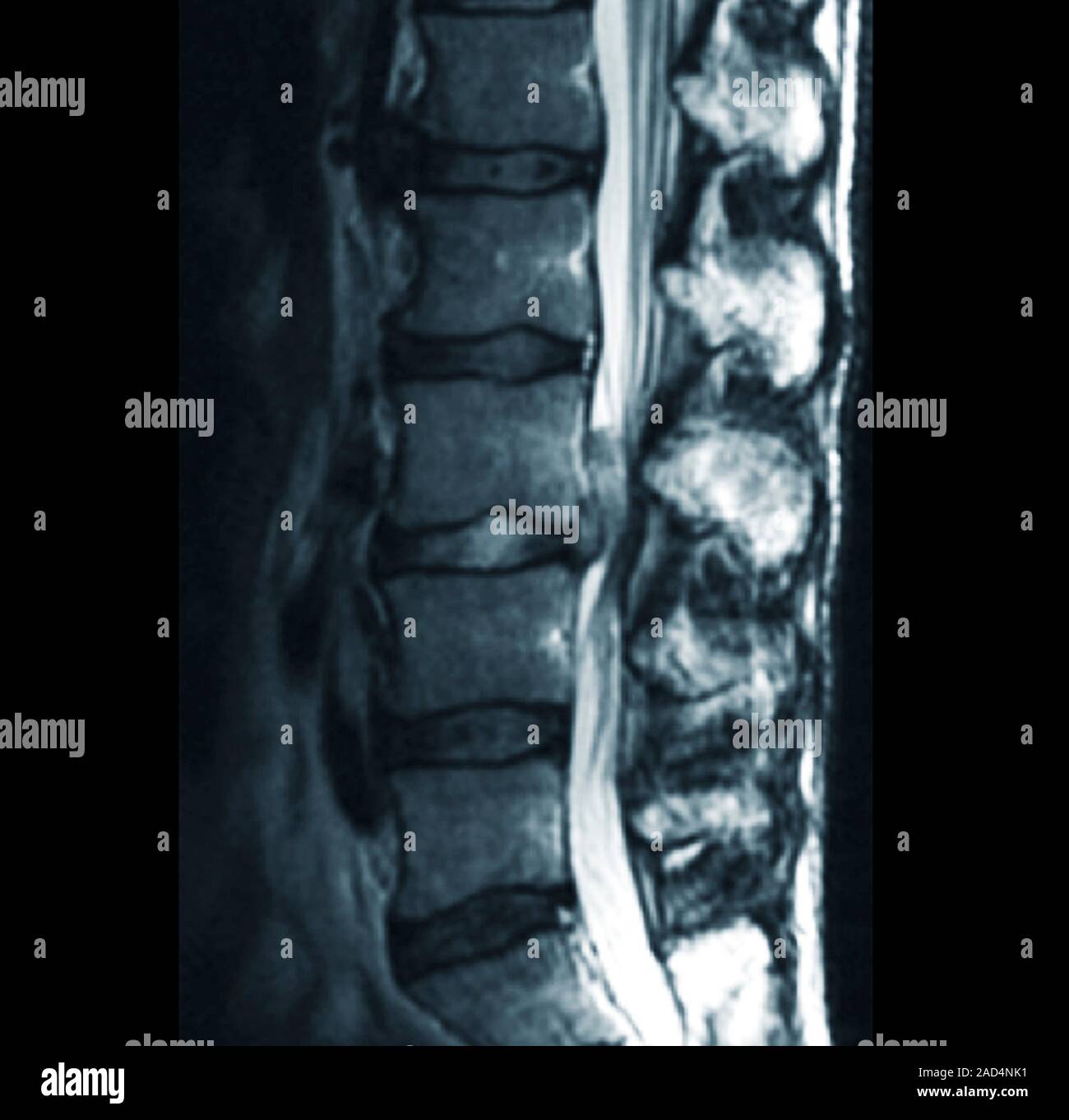 Slipped disc. Magnetic resonance imaging scan of a sagittal section ...