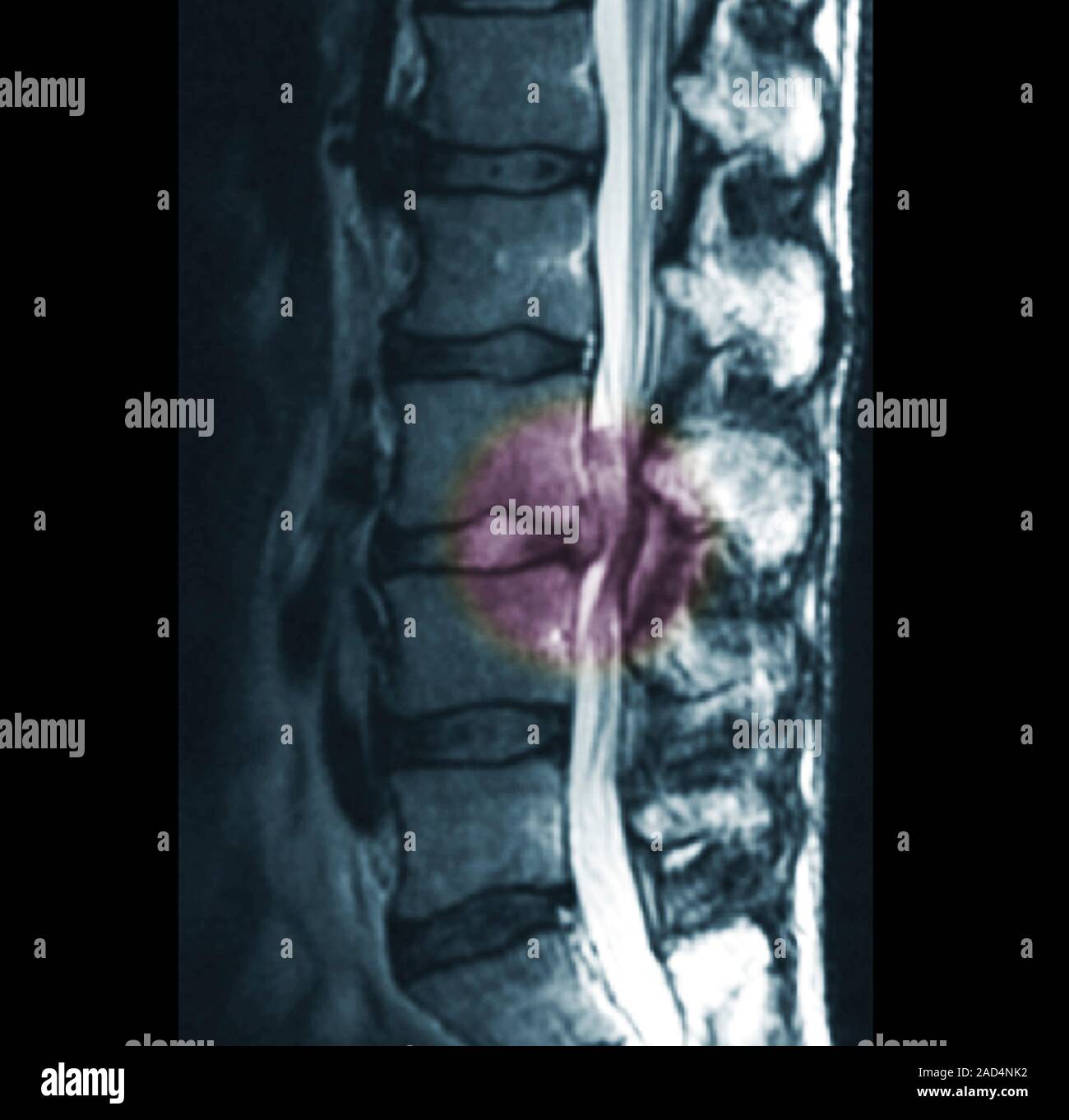 Slipped disc. Magnetic resonance imaging scan of a sagittal section ...