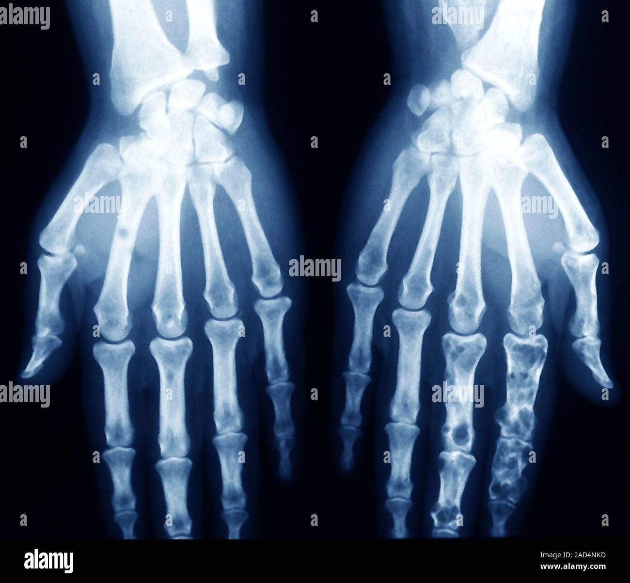 Hands in chondrodystrophy. Coloured X-ray of a section through the ...