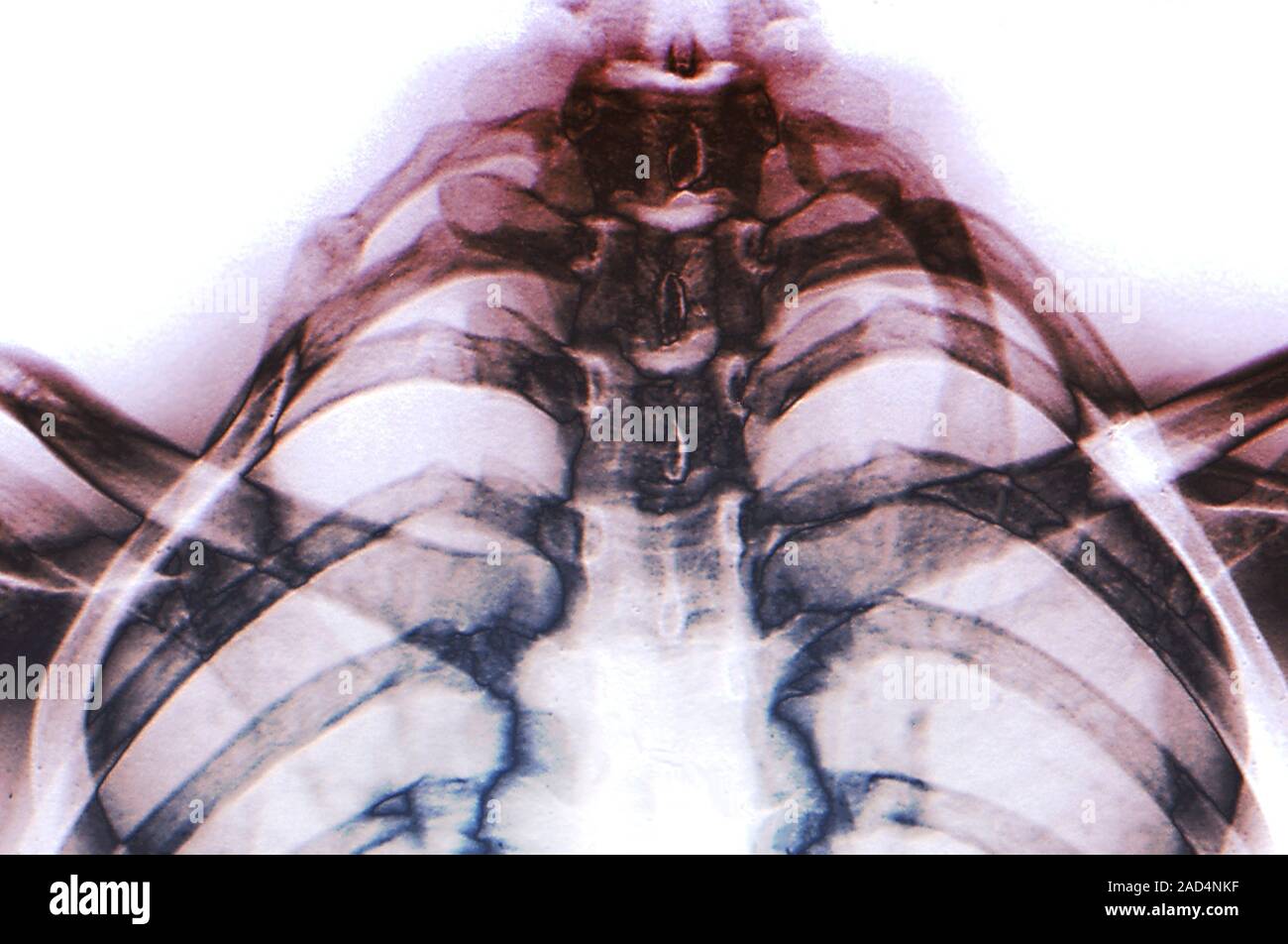 Extra rib. Coloured frontal X-ray of a section through the chest of a ...