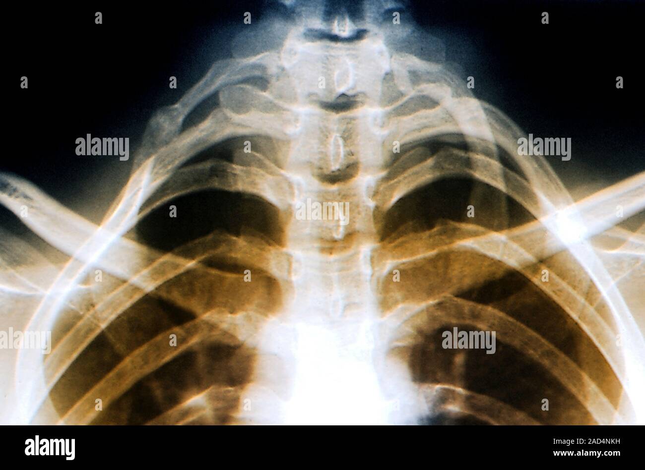 Extra rib. Coloured frontal X-ray of a section through the chest of a ...
