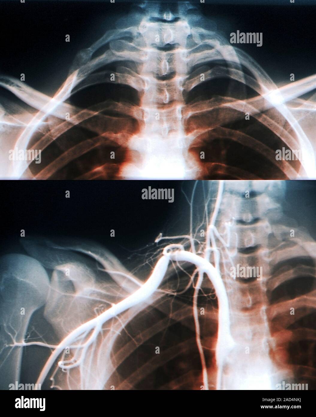 Extra rib. Coloured frontal X-ray (top) of the chest of a 27-year-old ...
