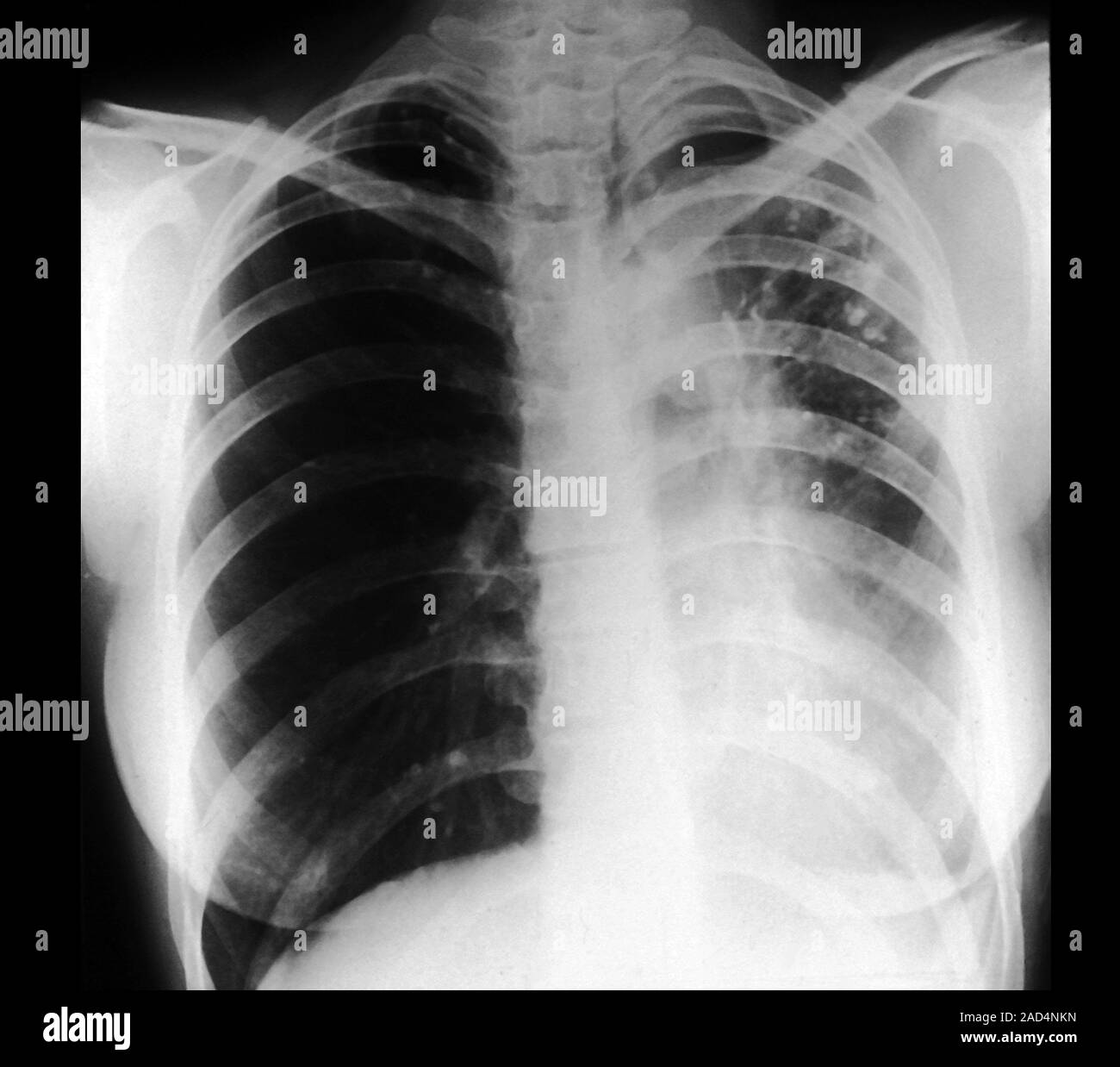 Bronchiectasis. Frontal bronchogram (X-ray) of a section through the ...
