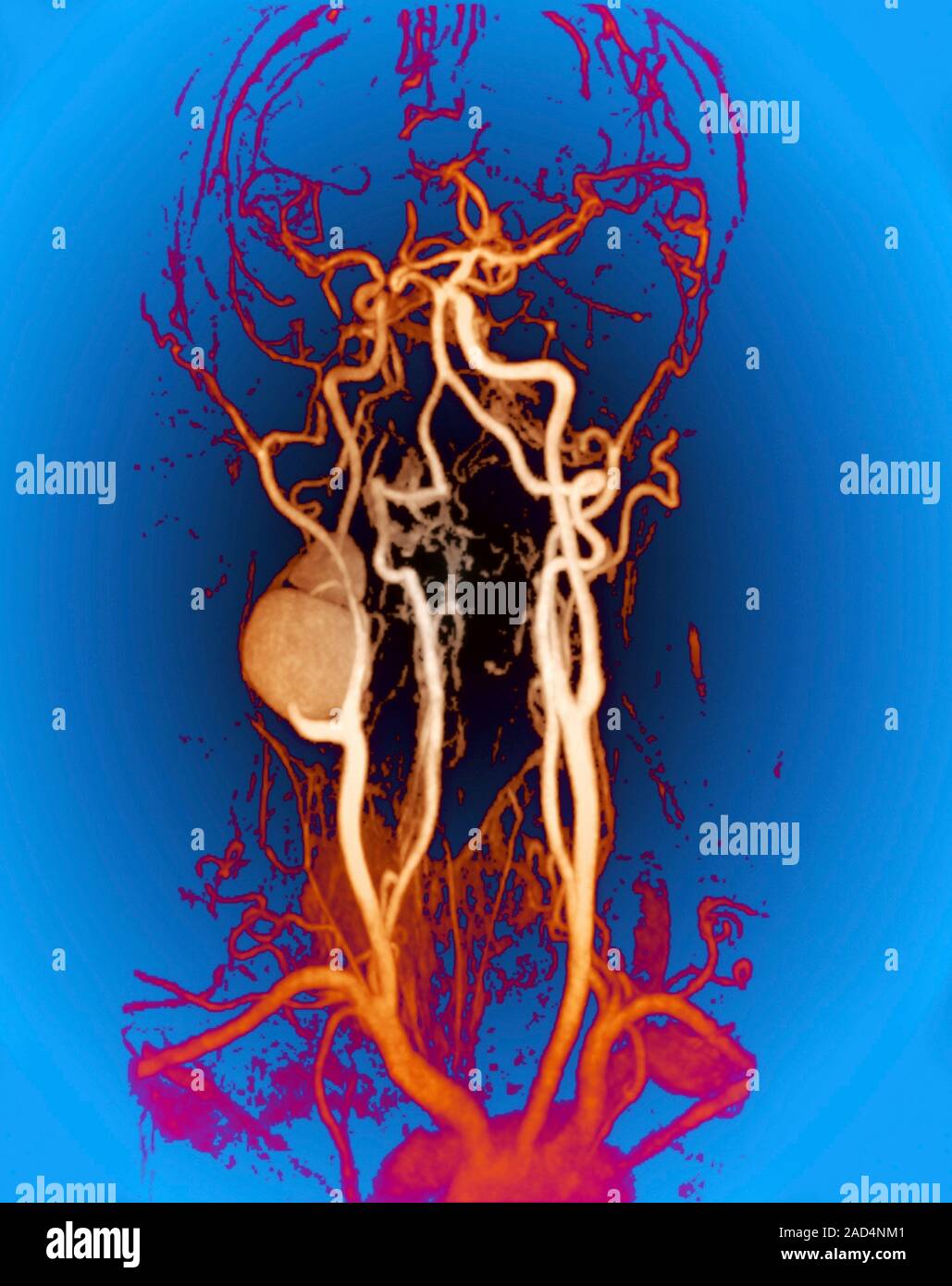 Carotid aneurysm. Coloured magnetic resonance imaging (MRI) scan of a ...