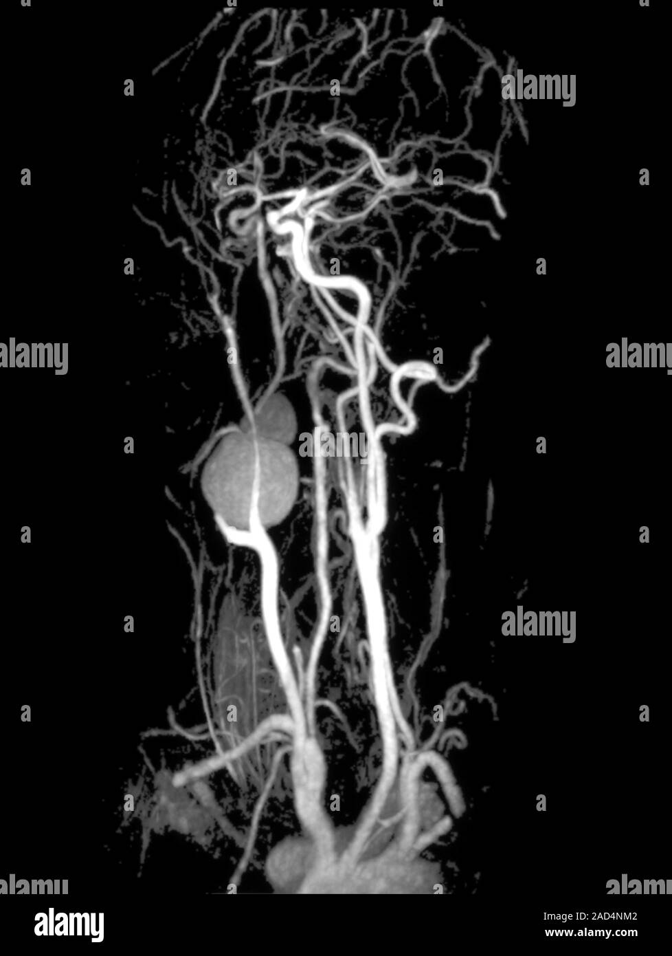 Carotid aneurysm. Magnetic resonance imaging (MRI) scan of a section ...