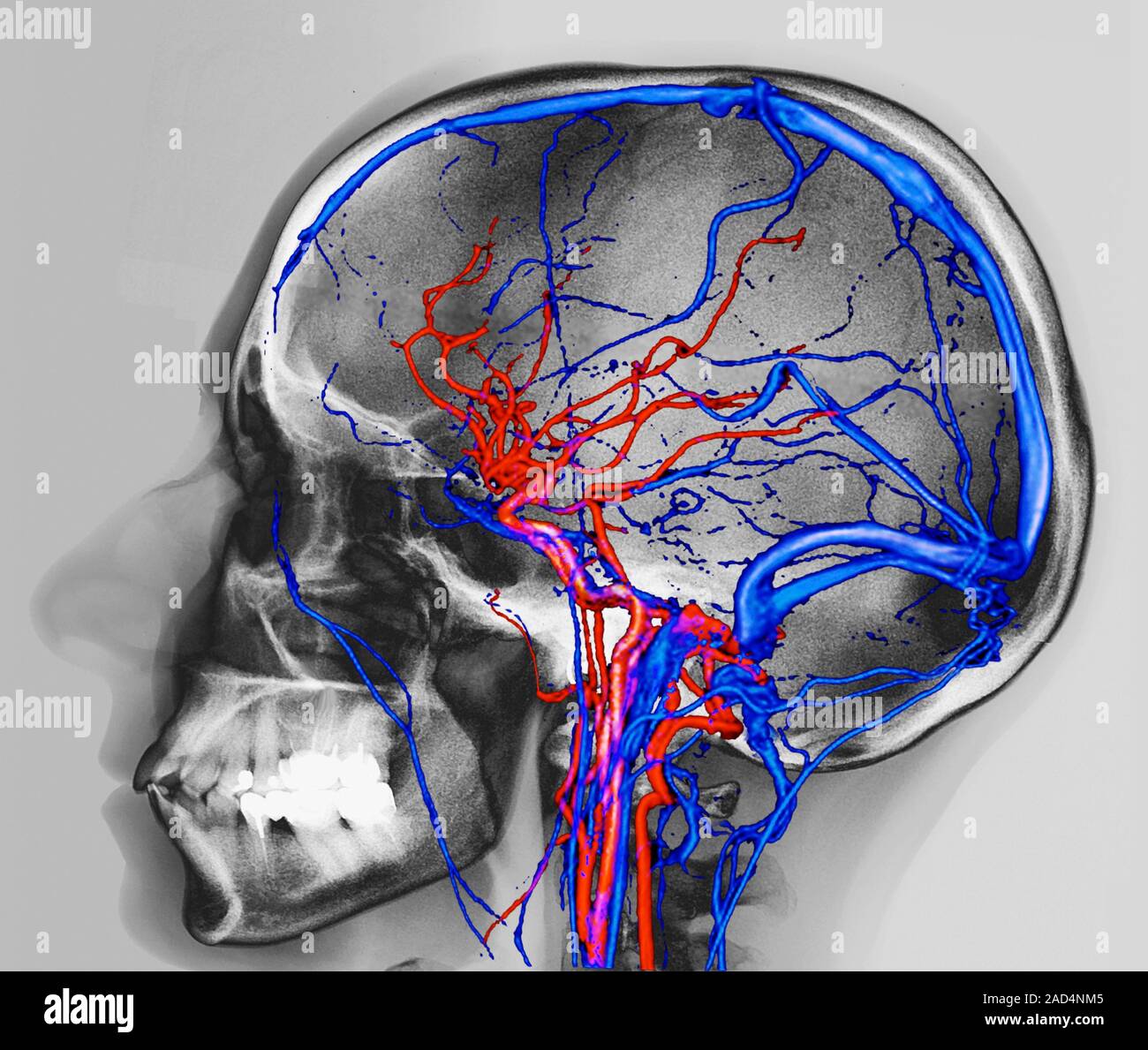 Normal brain blood supply. Coloured magnetic resonance imaging (MRI ...