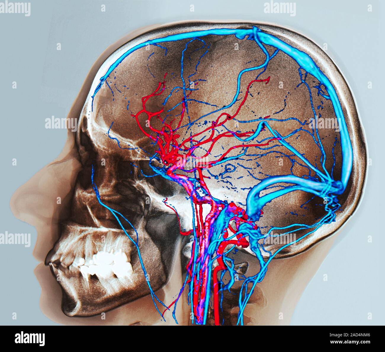 Normal brain blood supply. Coloured magnetic resonance imaging (MRI ...