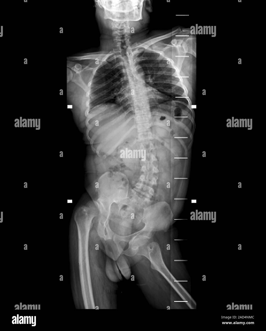 Spinal deviation in polio. X-ray of a section through the torso of a 35 ...