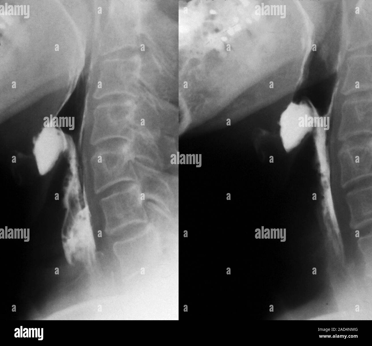 Laryngeal tumour. X-rays of sections through the throat of a 57-year ...