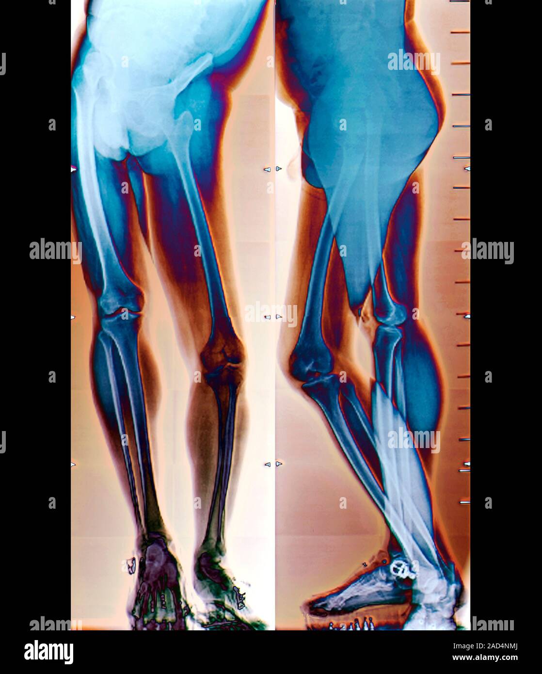Growth defect in polio. Coloured X-ray of a section through the legs of ...