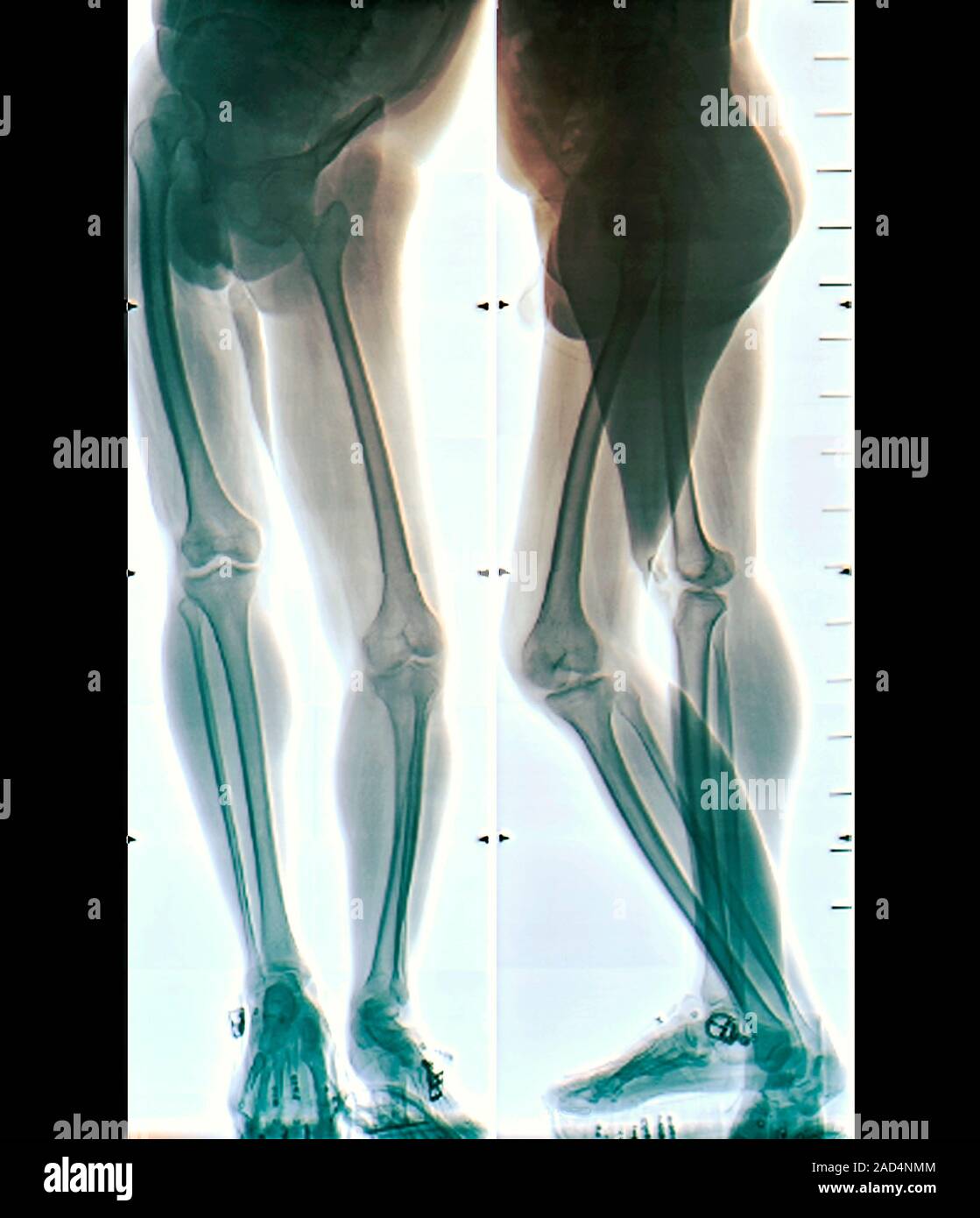 Growth defect in polio. Coloured X-ray of a section through the legs of ...