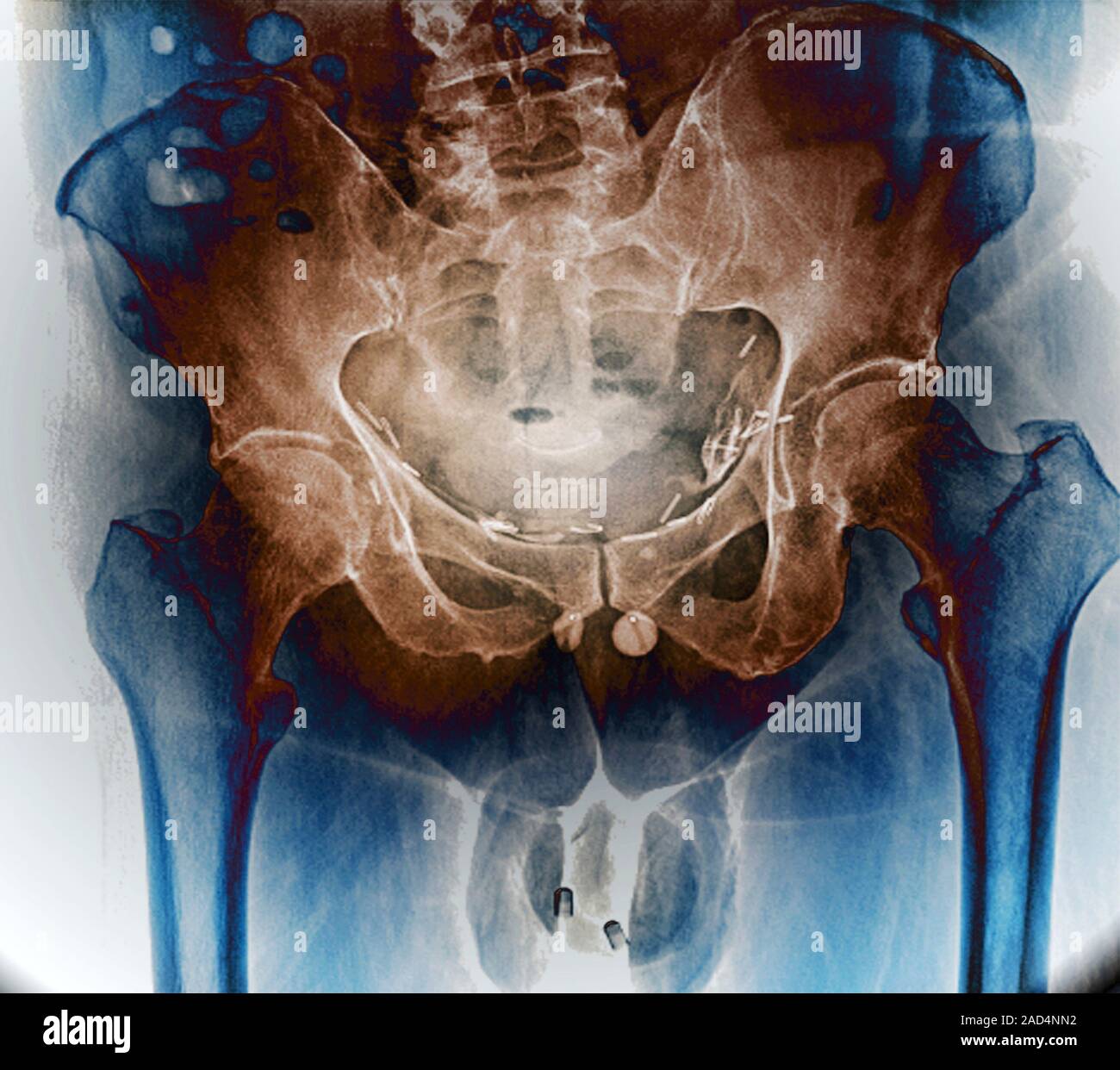 Incontinence implant. Coloured frontal X-ray of the pelvic region of a ...