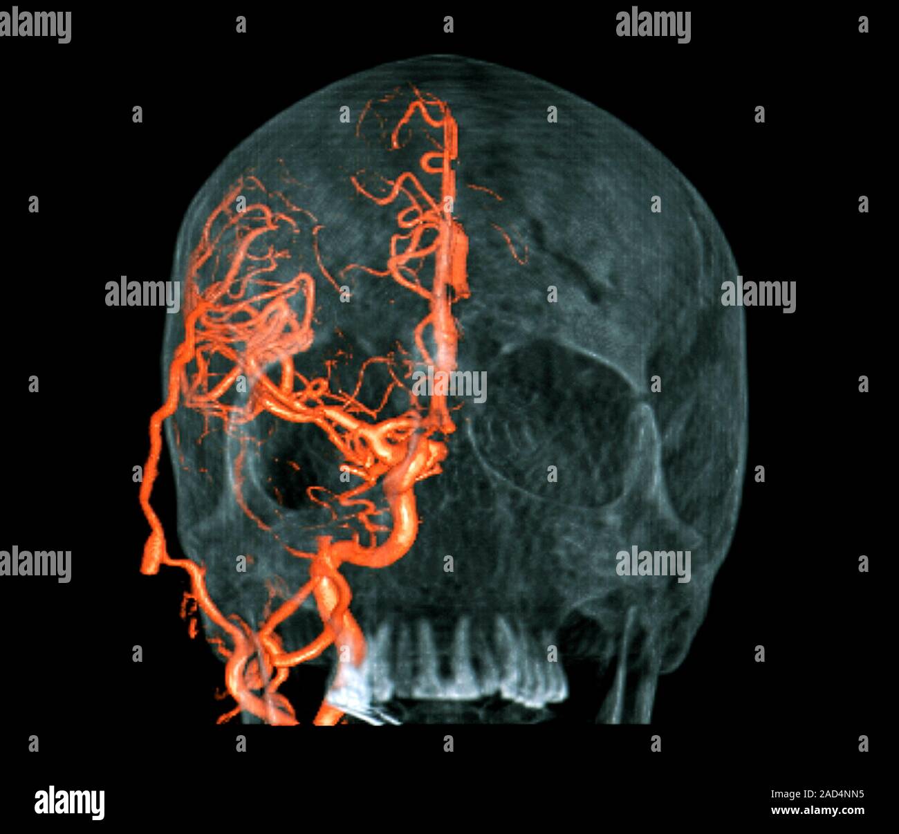 Brain haemorrhage. Coloured frontal 3D computed tomography (CT) angiogram of the head of a 42 ...