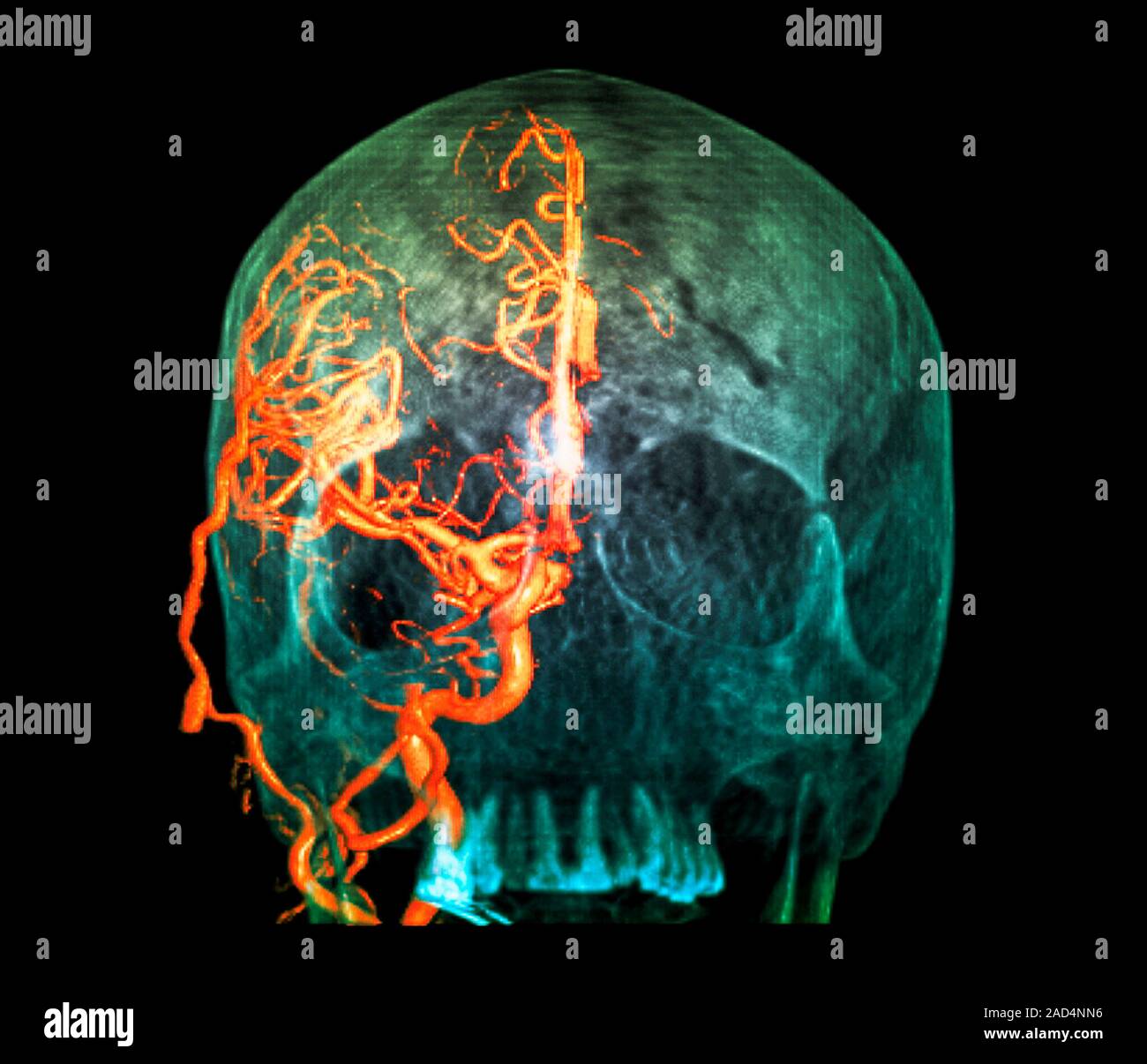 Brain haemorrhage. Coloured posterior 3D computed tomography (CT) angiogram of the head of a 42 ...