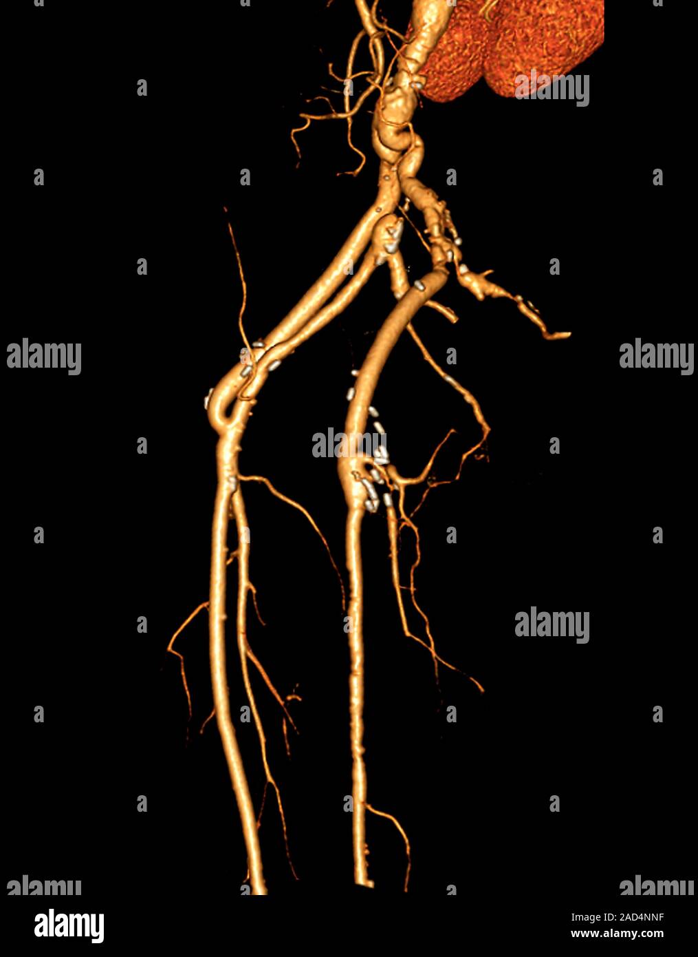 Arterial bypass. Coloured 3D computed tomography (CT) angiogram of the ...