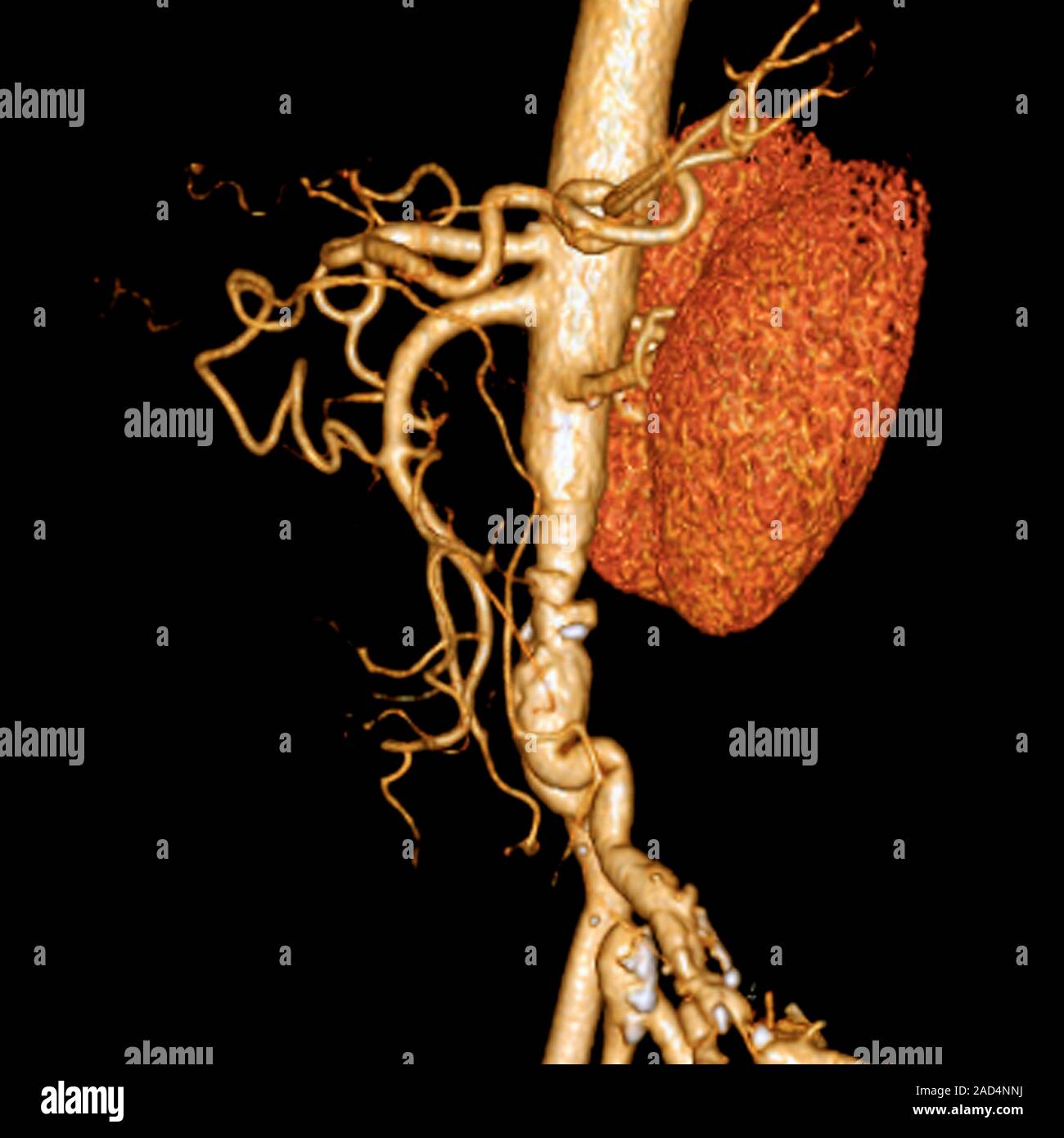 Arterial bypass. Coloured 3D computed tomography (CT) angiogram of the iliac and femoral ...