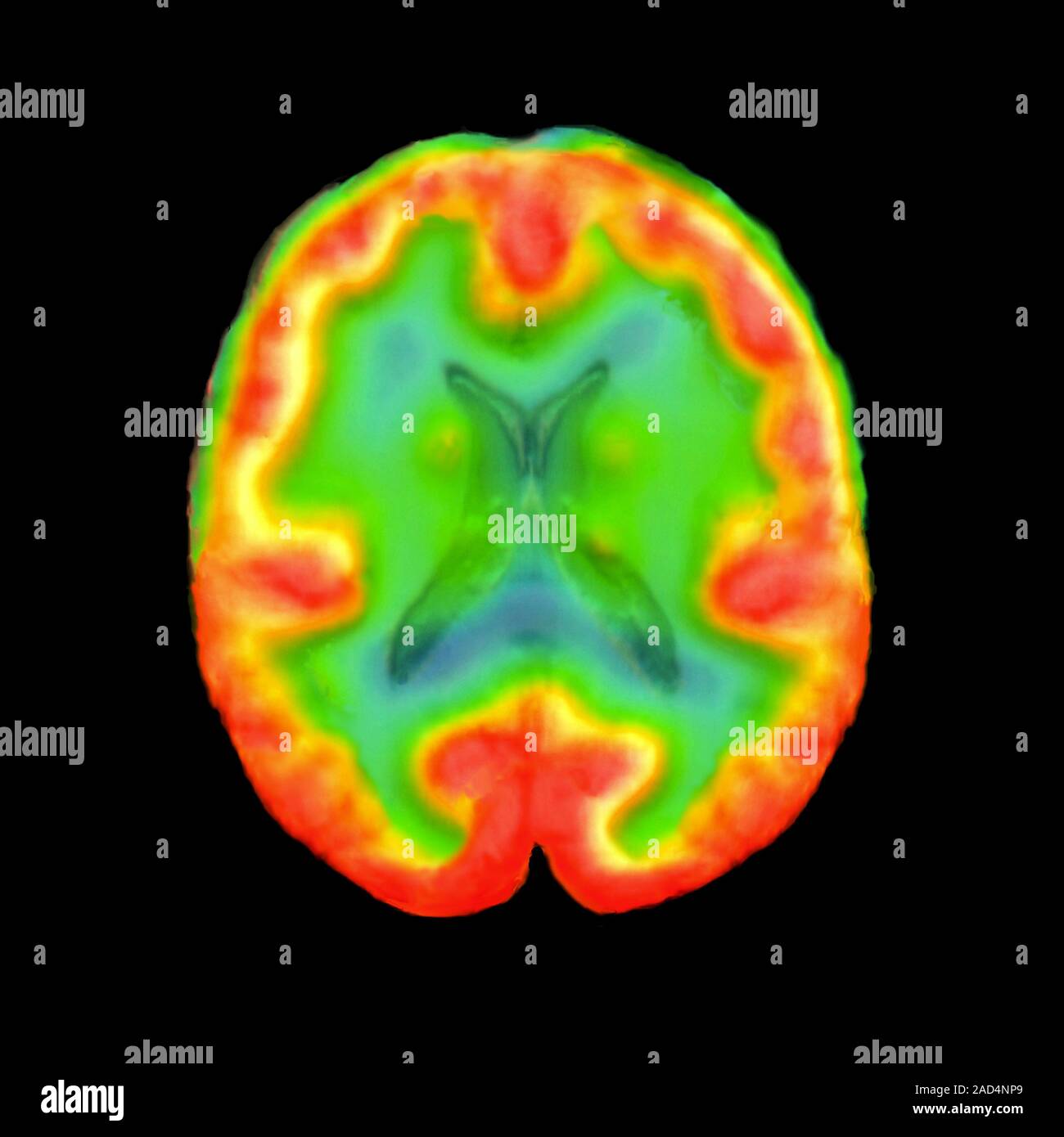 Normal brain blood flow. Single-photon emission computed tomography ...