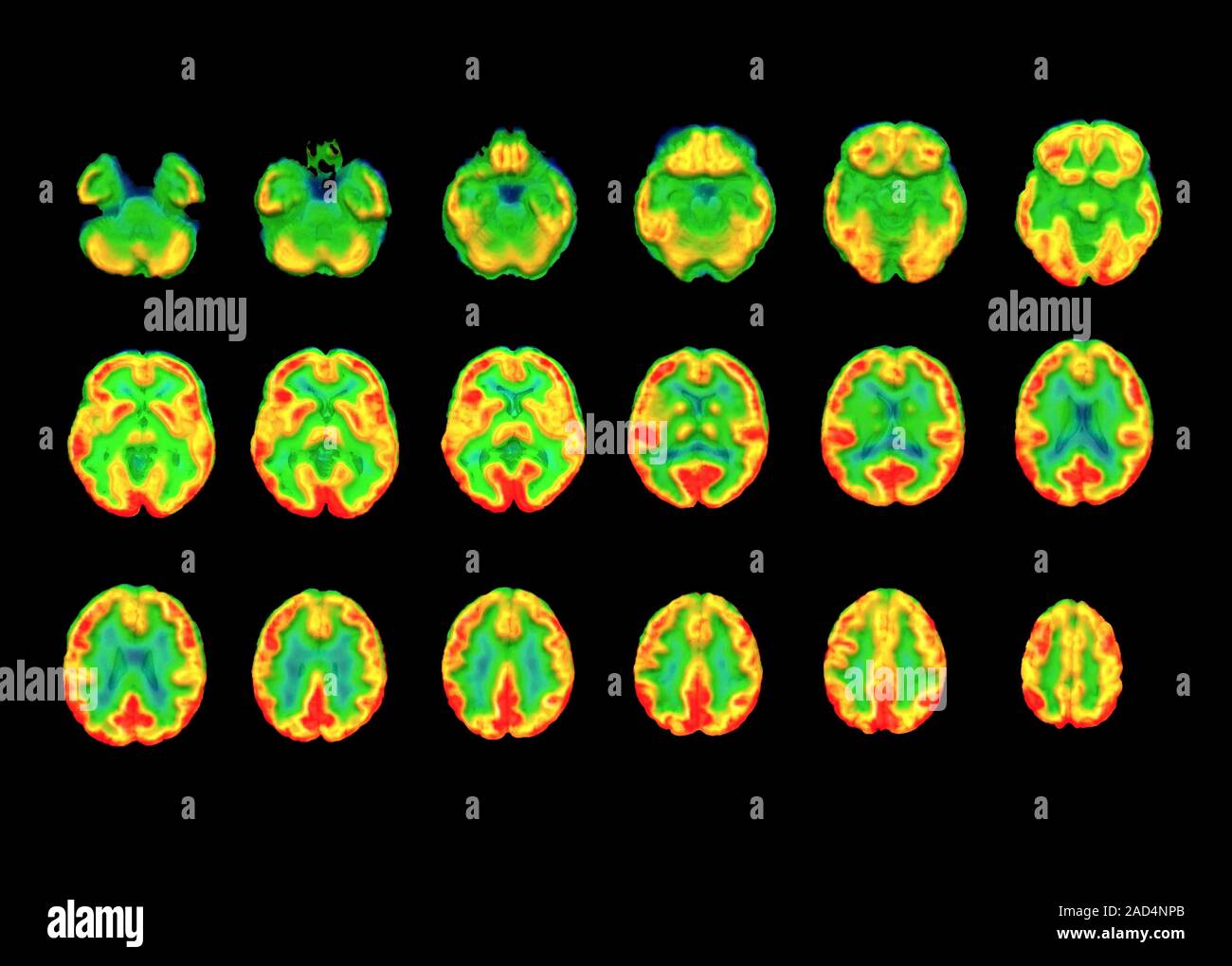 Brain in Alzheimer's disease. Single-photon emission computed ...