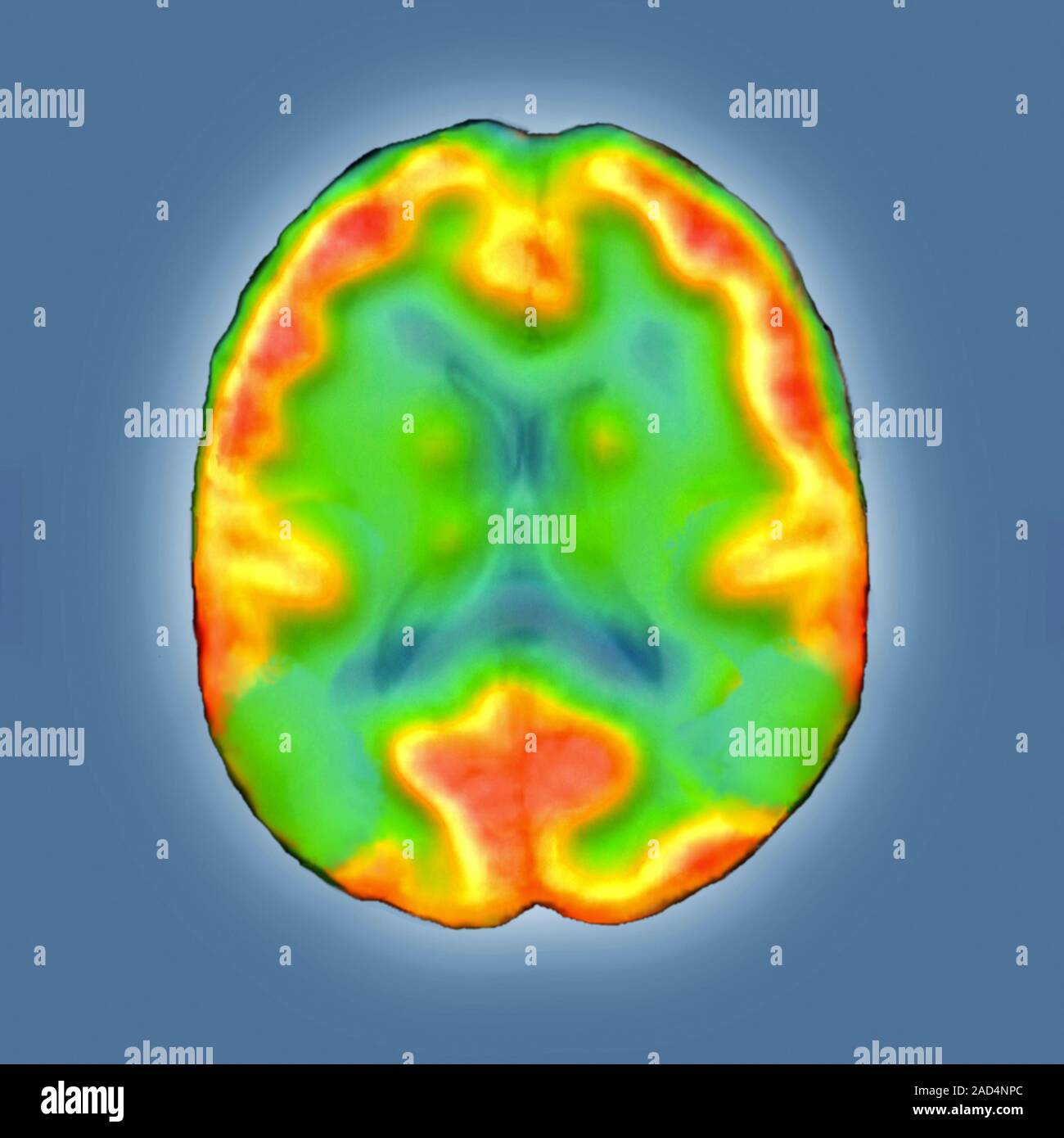 Brain in Alzheimer's disease. Single-photon emission computed ...