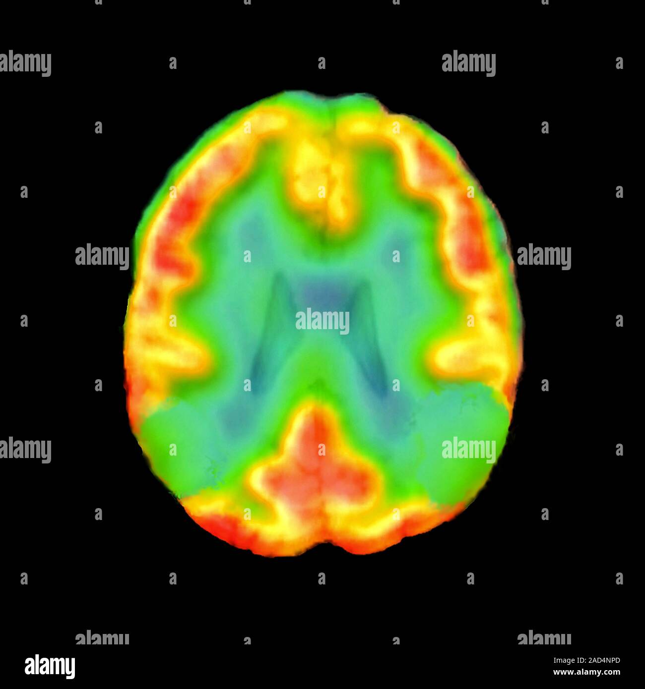 Brain in Alzheimer's disease. Single-photon emission computed ...