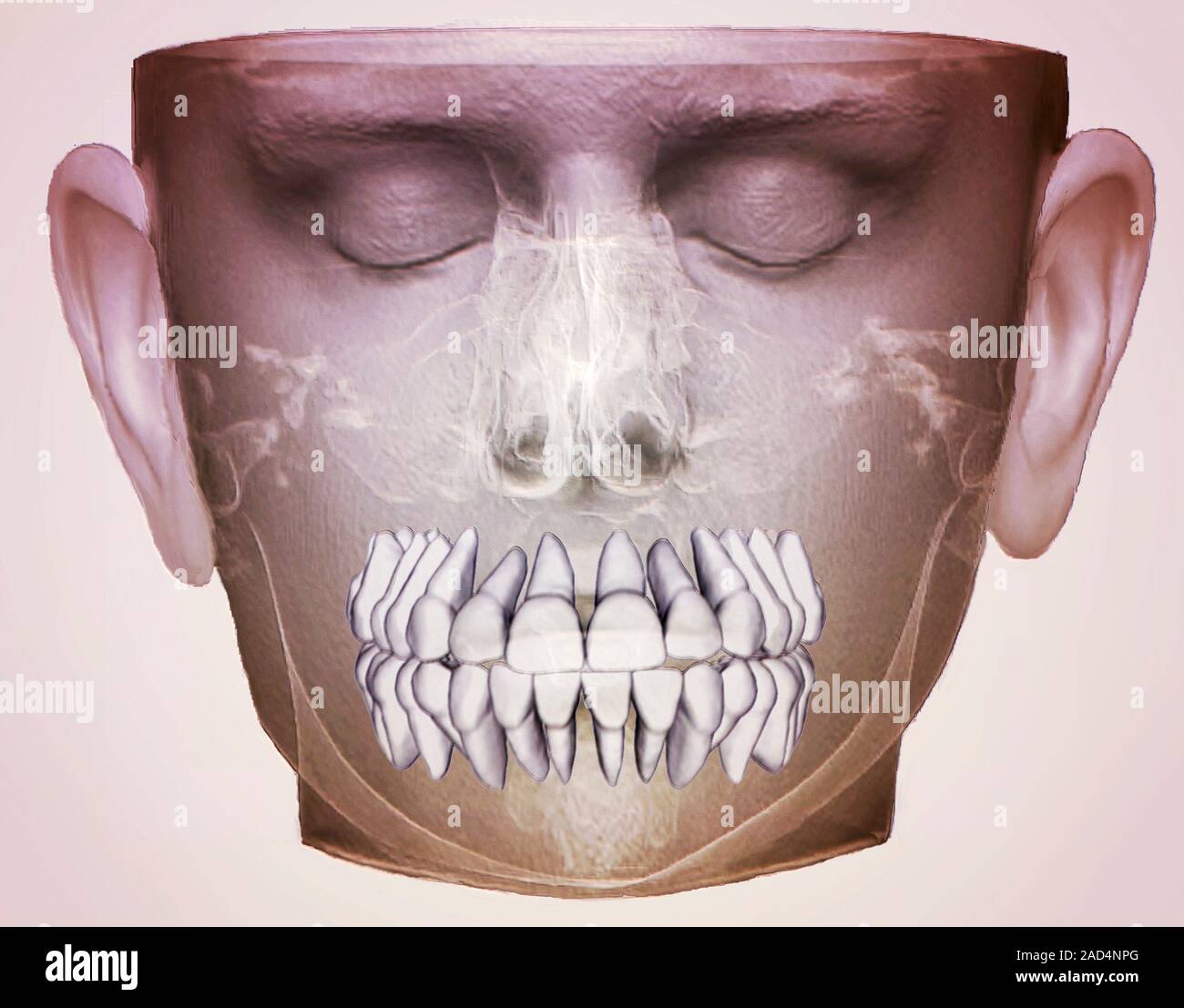 Normal teeth. Coloured 3D cone beam computed tomography (CBCT) scan of ...