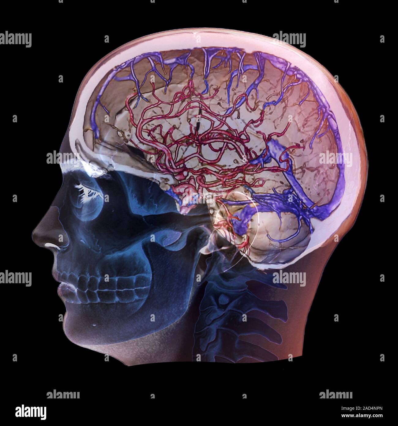 Normal brain blood supply. 3D computed tomography (CT) angiogram of a ...