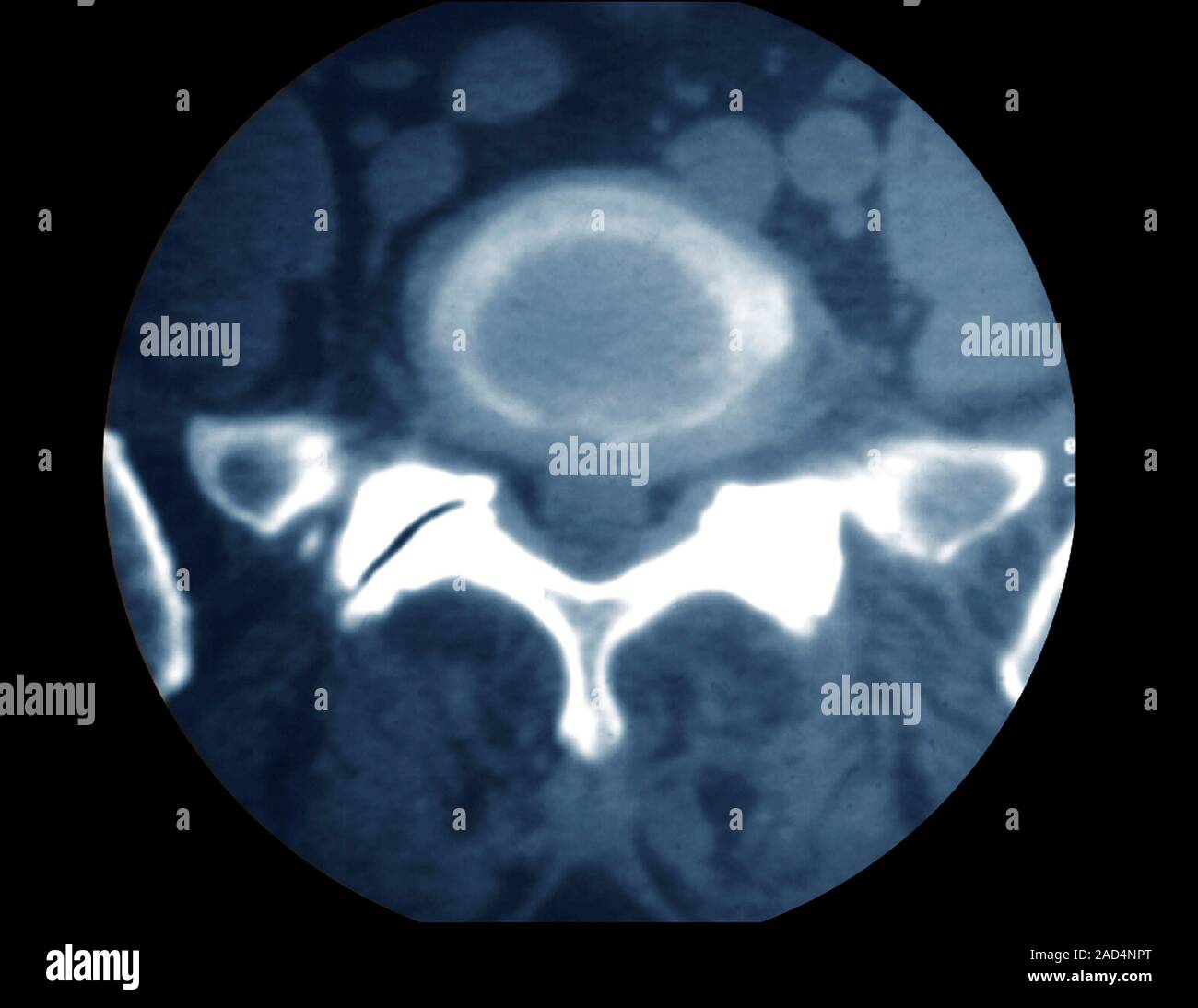 Spinal disc degeneration. Computed tomography (CT) scan of a section ...