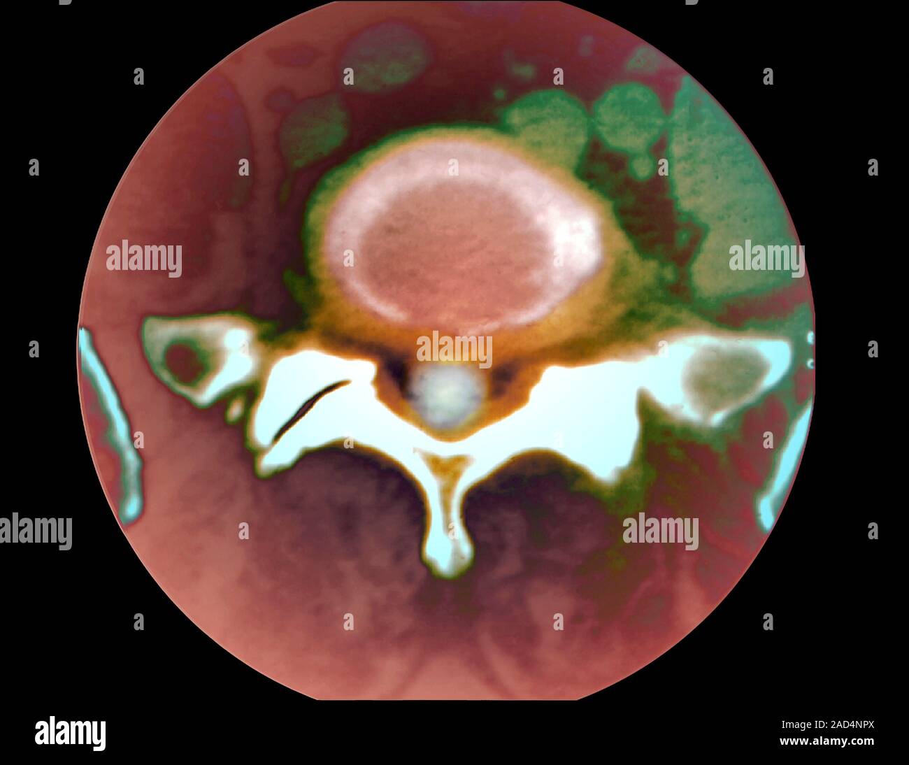 Spinal disc degeneration. Coloured computed tomography (CT) scan of a ...