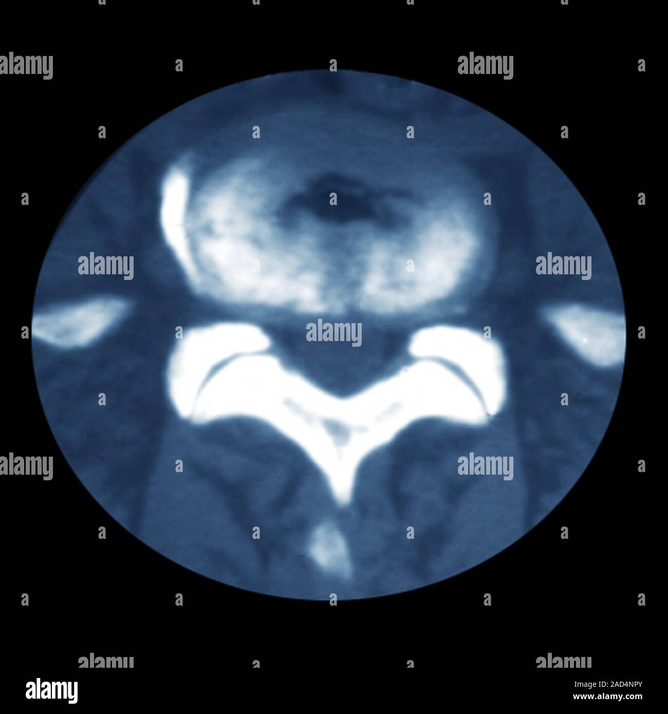 Spinal disc protrusion. Computed tomography (CT) scan of an axial ...