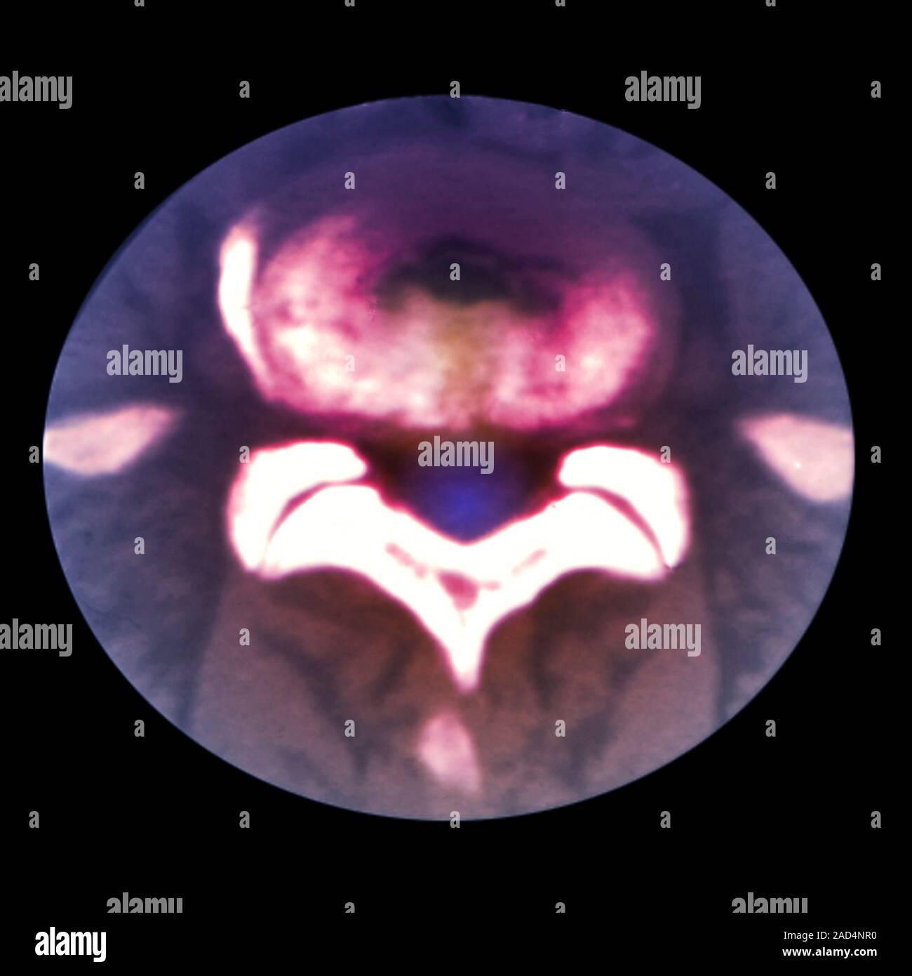 Spinal disc protrusion. Coloured computed tomography (CT) scan of an ...