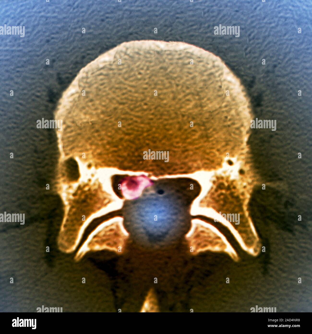 Slipped disc. Coloured frontal computed tomography (CT) scan of a ...