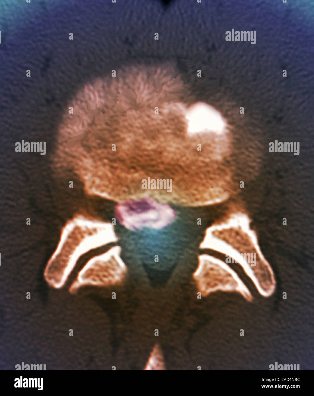 Slipped disc. Coloured frontal computed tomography (CT) scan of a ...
