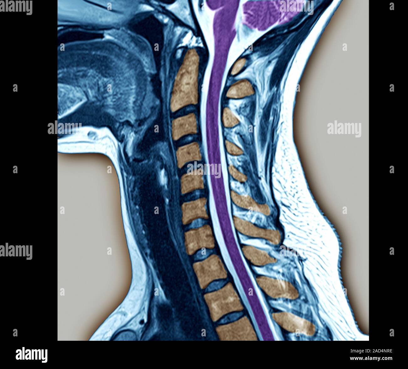 Normal lumbar vertebra. Coloured magnetic resonance imaging (MRI) scan ...