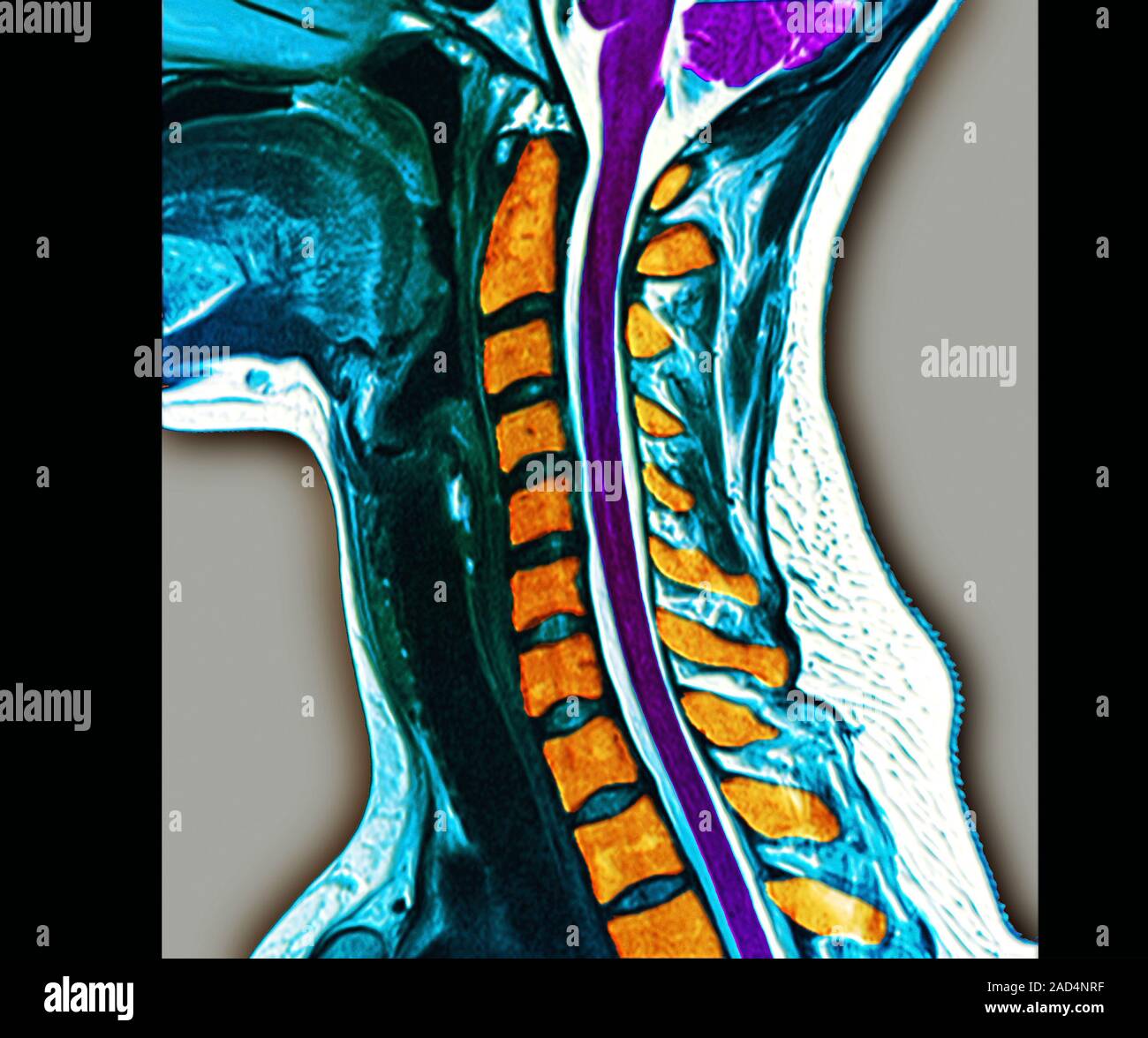 Normal lumbar vertebra. Coloured magnetic resonance imaging (MRI) scan ...