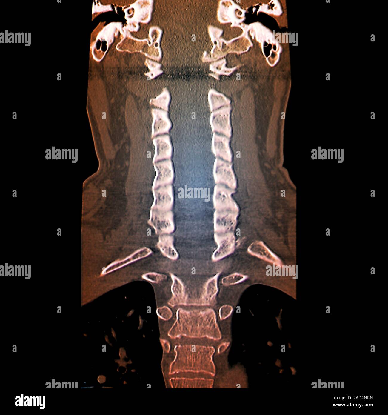 Normal lumbar vertebra. Coloured computed tomography (CT) scan of a ...