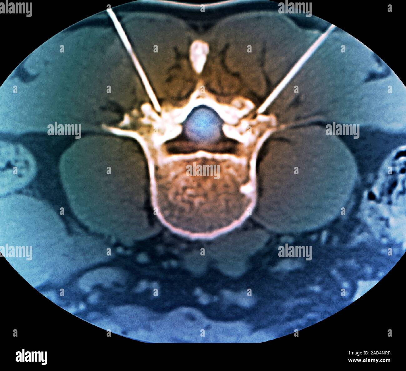 Spondylolysis treatment. Coloured computed tomography (CT) scan of a ...