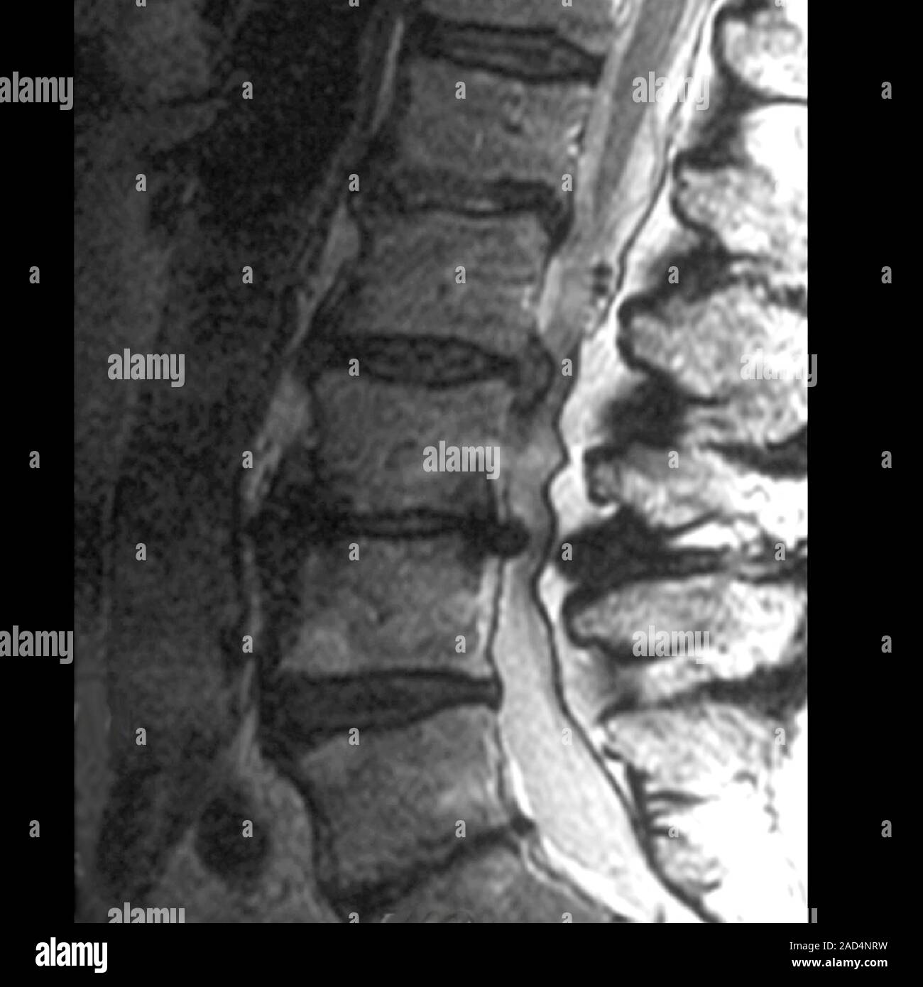 Slipped disc in spinal stenosis. Magnetic resonance imaging (MRI) scan ...
