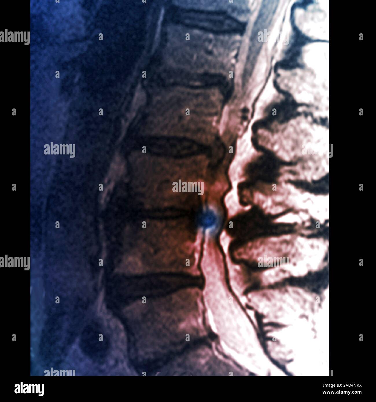 Slipped disc in spinal stenosis. Coloured magnetic resonance imaging (MRI) scan of a sagittal ...