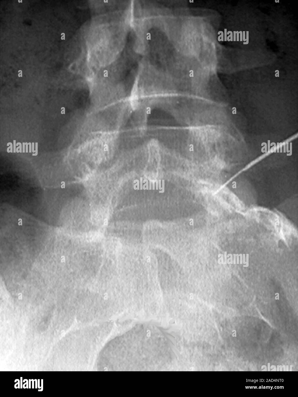 Spinal anti-inflammatory injection. X-ray of a section through the ...