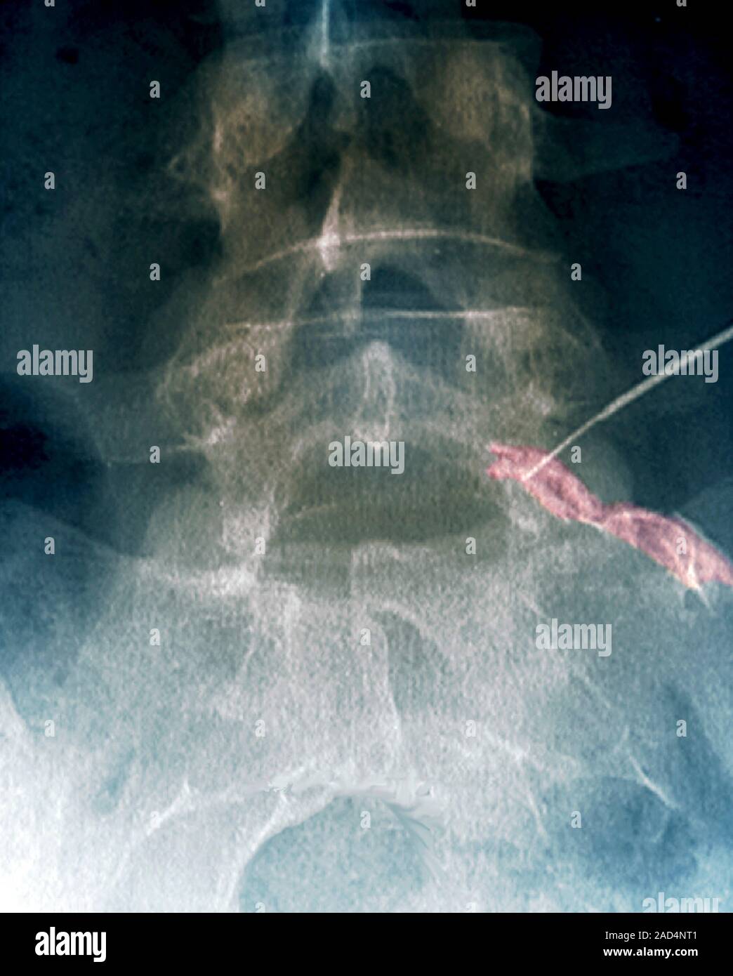 Spinal anti-inflammatory injection. Coloured X-ray of a section through ...